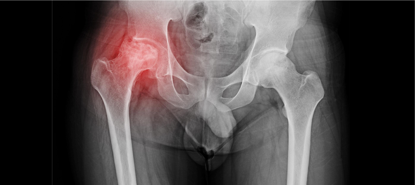 Avascular Necrosis (AVN) Treatment in Delhi - Dr. Ishwar Bohra